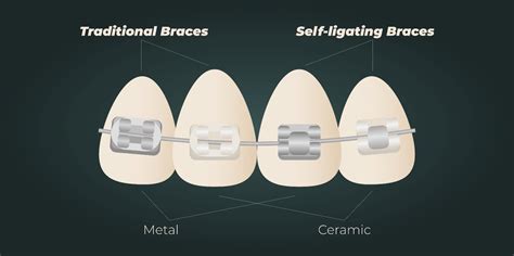 Dental Braces And Aligners Types Cost Procedure And Benefits