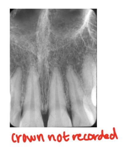 Week 2 Identification Of Intraoral Radiography Errors And Corrections