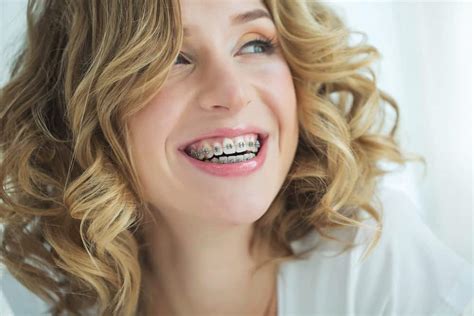 Things To Know About Metal Braces Are They Good For Your Teeth
