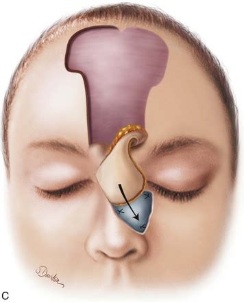 Interpolated Paramedian Forehead Flaps Clinical Gateclinical Gate