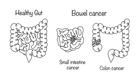 Uterine Cancer Fallopian Tube Royalty Free Vector Image