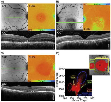 Autofluorescence Lifetimes In Central Serous Chorioretinopathy Cscr Download Scientific