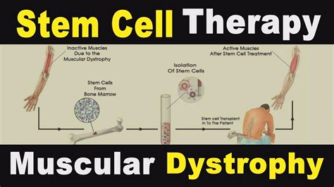 Muscular Dystrophy Stem Cell Treatment Captions Pages