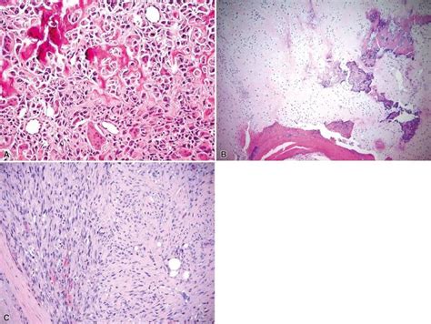 Lesions Characterized By Osteoid Deposition And Aggressive Radiology Located Within Bone