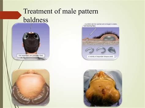 Tissue Expanders In Oral And Maxillofacial Surgery Pptx