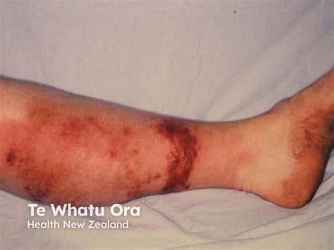 Cellulitis Mimics