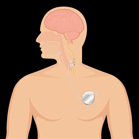 Peripheral Nerve Stimulation Suvar Md