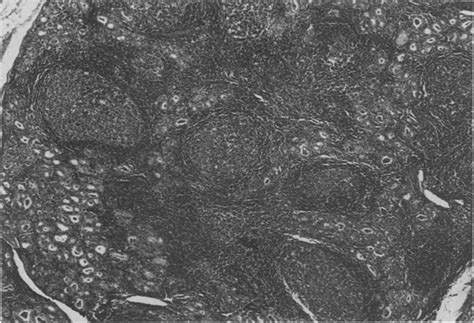 Hashimoto Thyroiditis Germinal Centers Difference Between Germinal