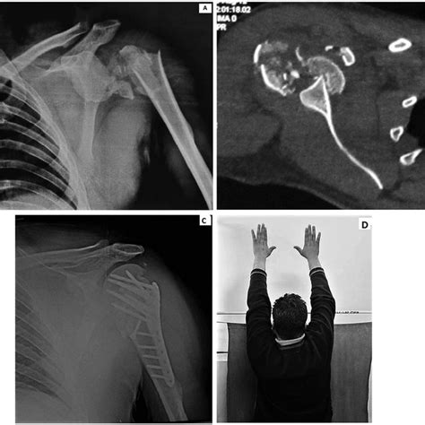 A 37 Year Old Man Sustained A 4 Part Anterior Fracture Dislocation Of