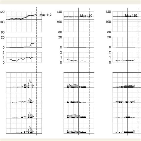 Concordance Of Microvolt T Wave Alternans Test Results Download Table