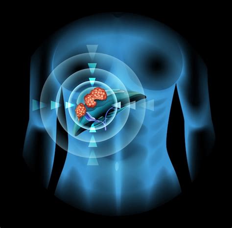 [diagram] Skin Cancer Diagrams Body Map Mydiagram Online