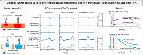Intracardiac Electrogram Analysis May Allow For Prediction Of Lesion Transmurality After Pulsed