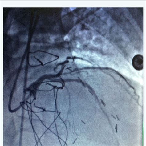 To Treat The Ramus Intermedius To Place A 25x22mm Endeavor Stent