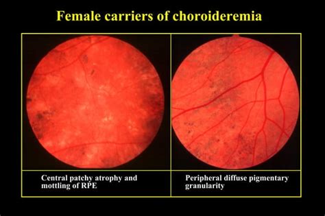 47 Hereditary Choroidal Dystropathies Ppt Eye And Vision Conditions