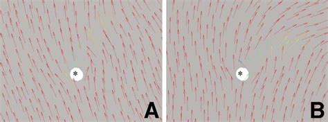 Local Hemodynamics Around The Stent Strut In The Perpendicular Plane To