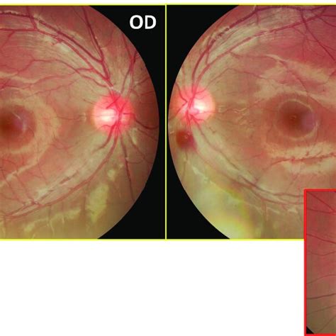 Fundus Photographs Taken 1 Week Aft Er Presentation Showing Hyperaemic