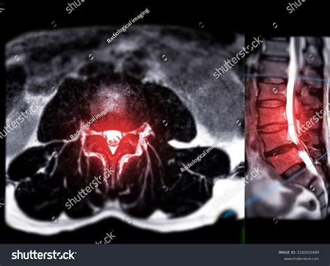 Lumbar Spine Mri Axial
