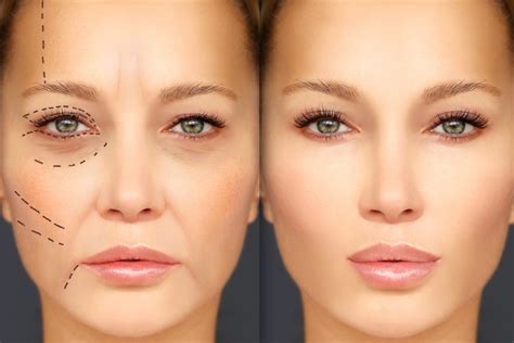 Understanding Dermal Fillers Types Benefits And Uses