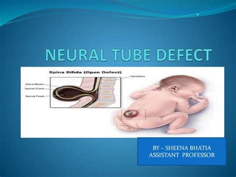 Neural Tube Defects Ppt