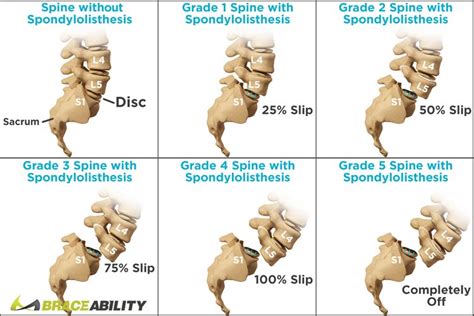 Meyerding Spondylolisthesis Spondylolisthesis Grading System Lqppm