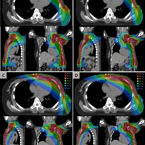 Examples Of Dose Distributions In The Final Submitted Imrt Or Vmat Plan Download Scientific