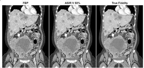 Patient Exam Reconstructed With Fbp Left An Iterative Algorithm
