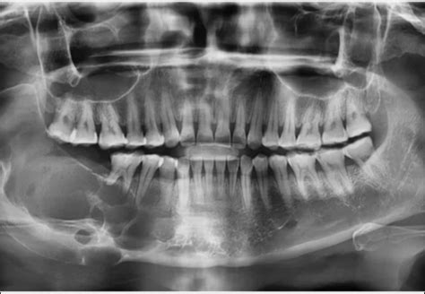 Ameloblastoma Causes Symptoms Treatment And Remedies