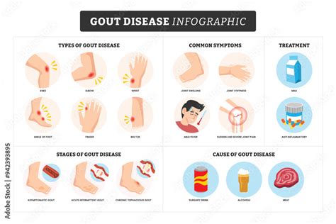 Gout Disease Infographic Medical Poster For Education Labeled Types Of Gout Disease Gout