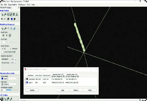 3d Volume Measurement Of K Endodontic File Using Itk Snap Software