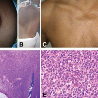 A Reddish Painless Nodules Over The Trunk B C Complete Download Scientific Diagram