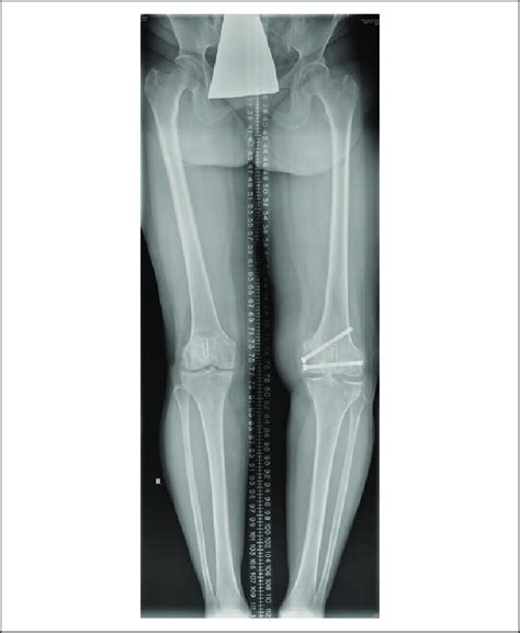 Postoperative Lower Limb Long Film Showing The Improved Left Lower Limb