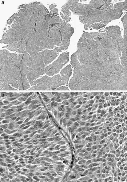 Low Grade Papillary Urothelial Carcinoma Of The Renal Pelvis With Download Scientific Diagram