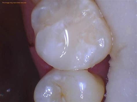 1 Surface Filling Vs 2 Surface Filling Differences 1311 Jackson Ave