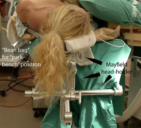 Posterolateral Neck Dissection Positioning And Surgical Steps Iowa