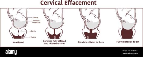 Vector Cervical Effacement And Dilatation During Labor Stock Vector