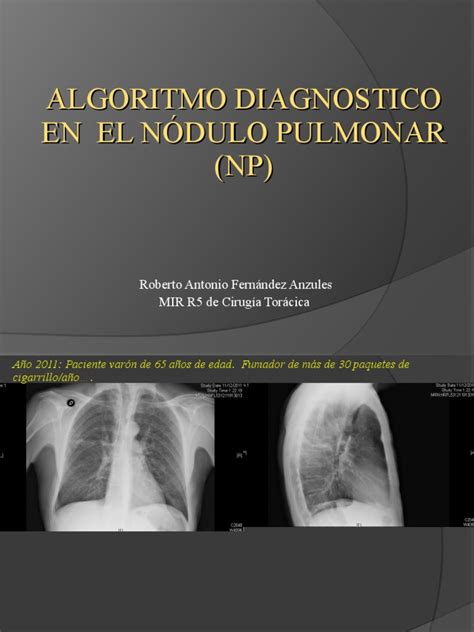 Algoritmo Diagnostico Para Nódulo Pulmonar Pdf Cáncer De Pulmón Cáncer