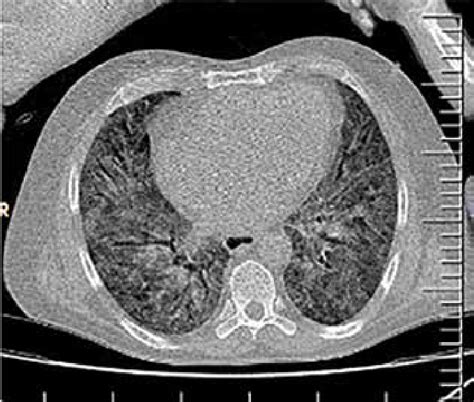 Simple Chest Computed Tomography Ct Download Scientific Diagram