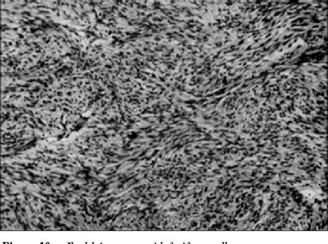 Figure 10 From Mesenchymal Non Epithelial Non Gist Tumors Of The