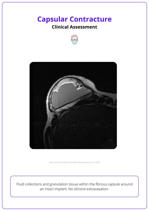 Capsular Contracture Aetiology Classification And Management