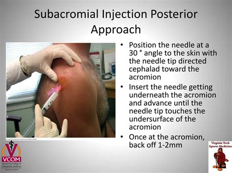 Subacromial Injection Landmarks Eroppa