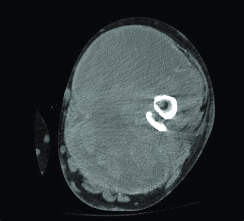 Axial Computed Tomography Ct Scan Showing The Soft Tissue Mass Almost Download Scientific