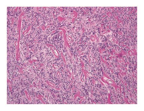 Microscopic Finding Of Resected Prostatic Tumor A He Staining B Download Scientific