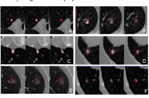Figure 2 From Enhancement And Segmentation Methods For Lung Cancer