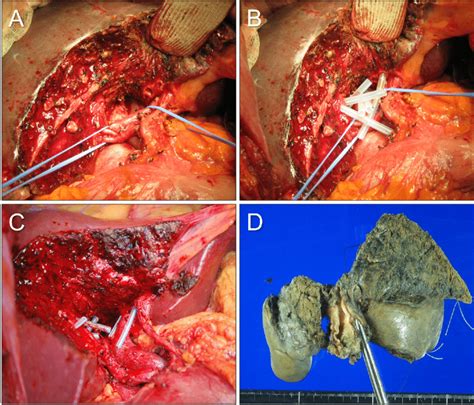 Intraoperative Intraoperative Photographs Showing Resection Of The