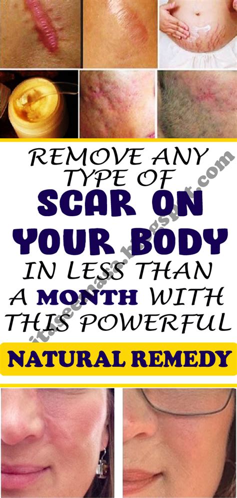 REMOVE ANY TYPE OF SCAR ON YOUR BODY IN LESS THAN A MONTH WITH THIS POWERFUL NATURAL REMEDY