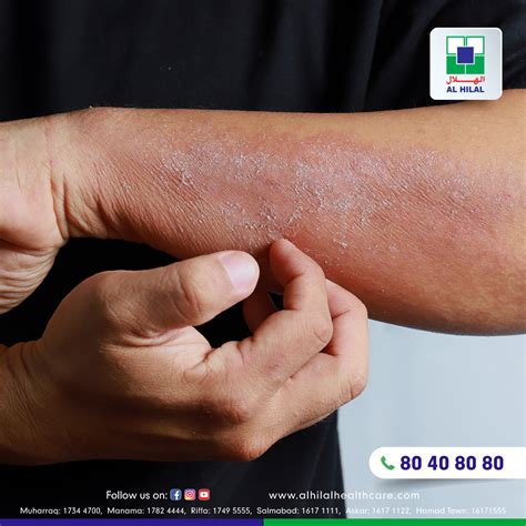Dermatitis Symptoms Diagnosis Treatment And Prevention