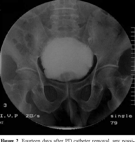 Figure 1 From Iatrogenic Bladder Perforation During Catheter