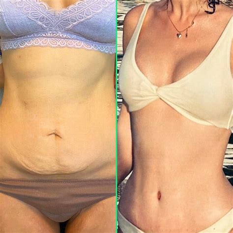 Get A Flatter Stomach Tummy Tuck Surgery In Istanbul
