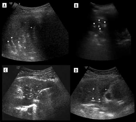 Ultrasound B Mode Consolidations A Bacterial Pneumonia And