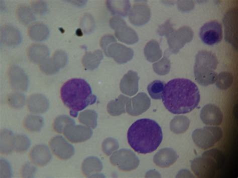 Eritroblasto Ortocromático Corpúsculo De Howeel Jolly Ou … Flickr